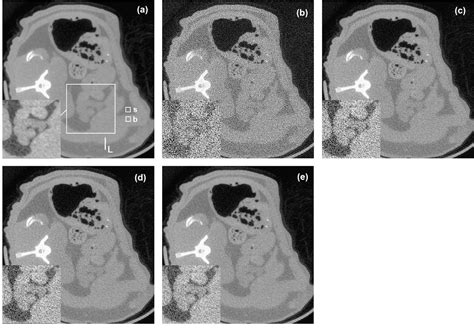 Figure 8 From A Denoising Algorithm For Projection Measurements In Cone Beam Computed Tomography