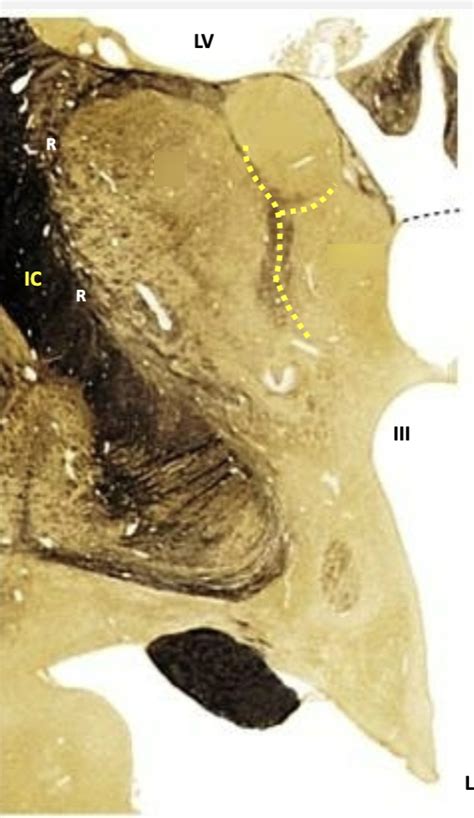 Anterior Thalamus Coronal Section Diagram Quizlet