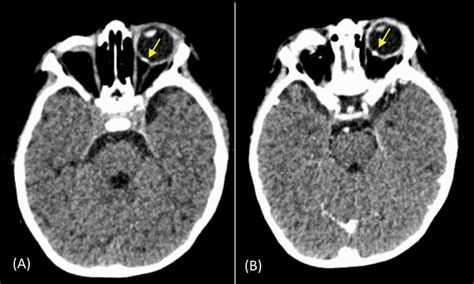 Axial Ct Scan Of The Orbits Non Contrast A And Contrast Enhanced Download Scientific