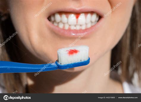 Bleeding Gums Scurvy