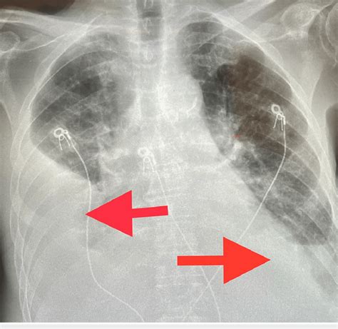 Chest X Ray Showing Large Right Sided And Moderate Leftsided Pleural