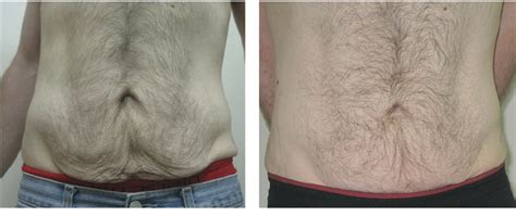 Loose Skin We Have Loose Skin Treatments Clarity Medical Spa In San