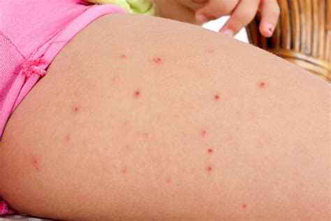 Foliculitis Qué es Tratamiento Centro Médico Estético Rusiñol