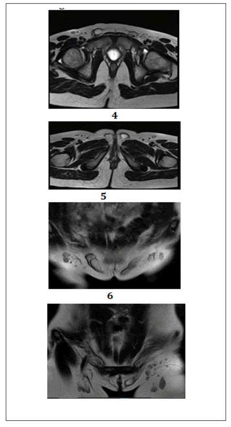 An Interesting Case Of Complete Androgen Insensitivity Syndrome Cais