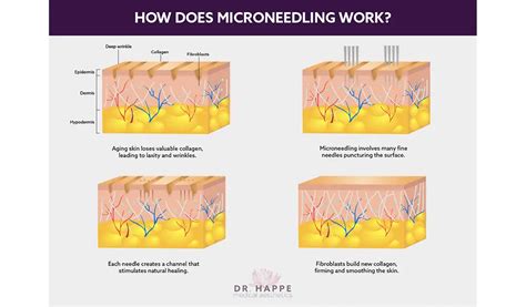 Microneedling Aftercare Radiant Skin Recovery