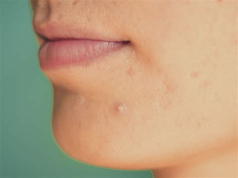 Sebaceous Hyperplasia Vivaskin Dermatology