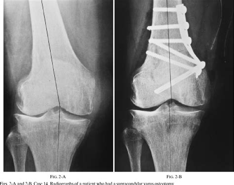Figure 2 From Supracondylar Osteotomy Of The Femur With Use Of Compression Osteosynthesis With