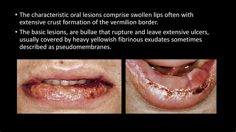 Non Plaque Induced Gingivitis Pptx