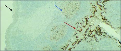 On Slide Positive And Negative Control Tonsillar Tissue The Cryptic Download Scientific