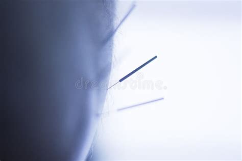 Dry Needling Acupunture Needles Stock Photo Image Of Alternative Acupuncture
