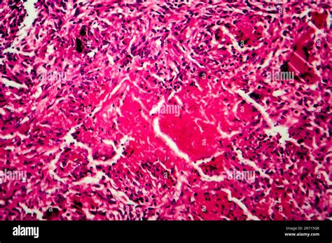 Miliary Tuberculosis Light Micrograph Photo Under Microscope Stock