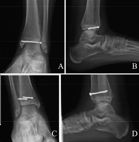 Anteroposterior A And Lateral B Radiographs Obtained 12 Months