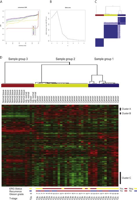 Consensus Based Cluster Analysis Of Gene Expression In Prostate Cancer
