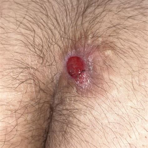Why Does My Pilonidal Cyst Look Like Scab That Never Heals R Pilonidalcyst