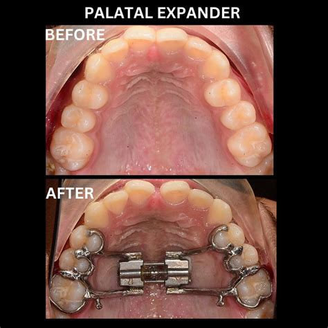 Palatal Expander Before And After Results At Fort Dental Clinic Mumbai