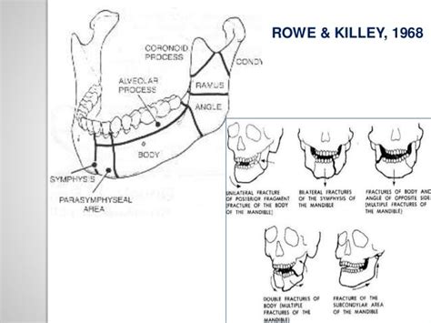 Classification Of Mandible Fracture