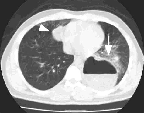 Echinococcus Infection Of The Lung Eurorad