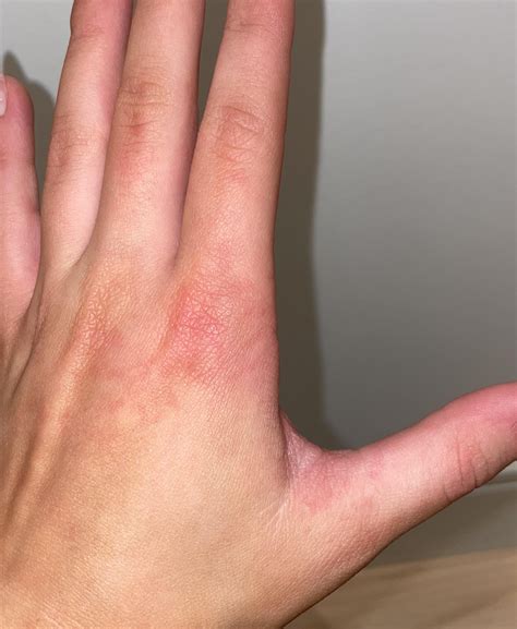 These Rashes Started On The Back Of My Hands And They Come And Go So