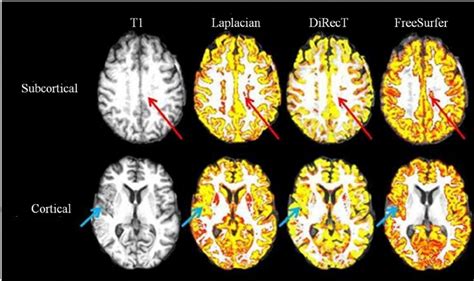 Stroke Site And Method Performance A Simple Comparison Of Cortical