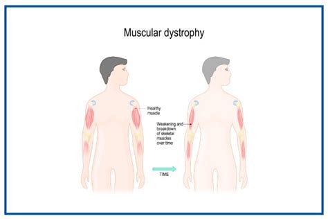 Muscular Dystrophy Symptoms