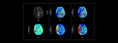 Ctp脑灌注智能分析系统 脑灌注人工智能 脑灌注ai 联影智能
