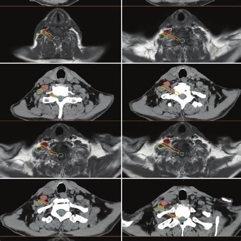 Pdf Brachial Plexus Contouring With Ct And Mr Imaging In Radiation