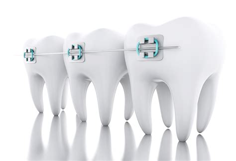 Gemini Braces Baker Street Dental