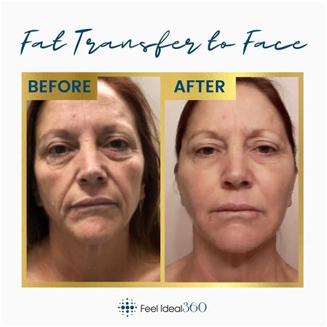 Specialty Before And After Feel Ideal 360 Med Spa Southlake Tx