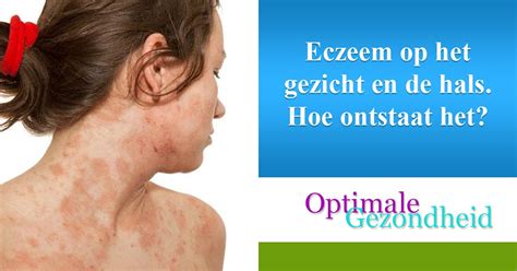 Eczeem Op Het Gezicht En Hals Wat Kun Je Zelf Doen
