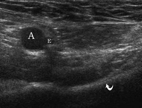 Ultrasound Pictures Of Inguinal Hernia Masturbation B
