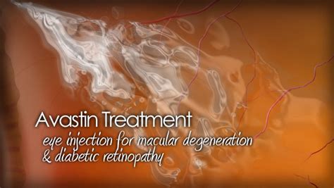 Avastin Treatment For Eye Disease And Macular Degeneration