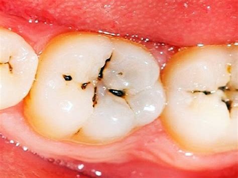 Dental Cavities Dental Cavities And Treatment Options Adedejiofakure