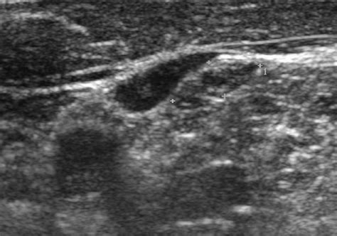 Us Image Of A 49 Year Old Male With Papillary Thyroid Carcinoma