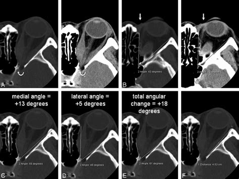 A And B Axial Ct Scans Bone Window On Left Soft Tissue Window On