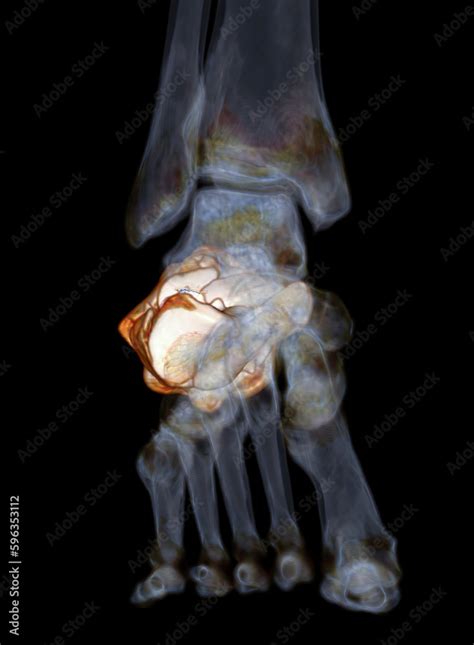 Ct Scan Ankle Joint With 3d Rendering Of Calcaneus Bone Showing Calcaneus Heel Bone Fractures