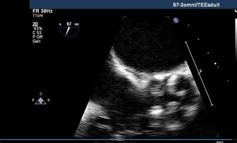 Endocarditis Due To Vancomycin Resistant Enterococcus Faecium