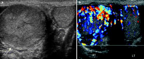 Testicular Cancer Imaging Radiology Key