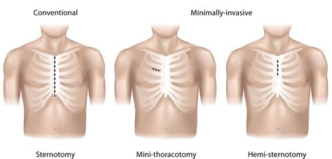 Minimally Invasive Aortic Valve Surgery Ucsf Surgical Oncology
