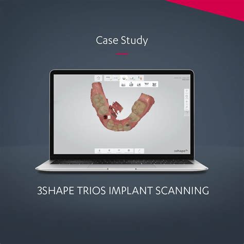 3shape Trios Implant Scanning Case Study