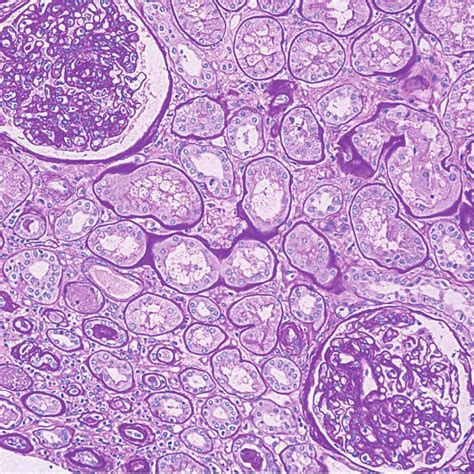 Tubulointerstitial Nephritis Including Tubular Atrophy Interstitial