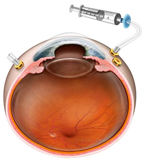 Vitreoretinal Surgery Setup Education Illustration