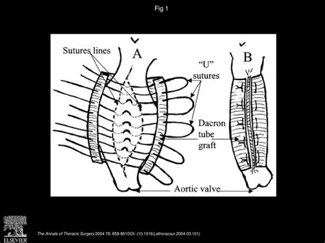 Reduction Aortoplasty And External Wrapping For Moderately Sized