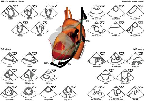 15 Transesophageal And Epicardial Echocardiography In Congenital Heart