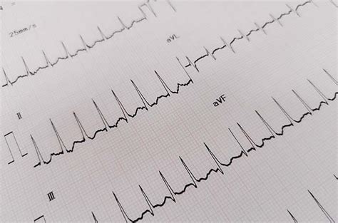 Begini Tes Diagnosis Untuk Deteksi Svt