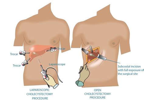 Laparoscopic Cholecystectomy Steps