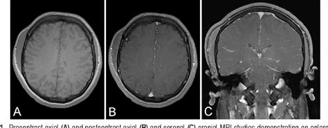 Figure 1 From Isolated Unilateral Temporalis Muscle Hypertrophy