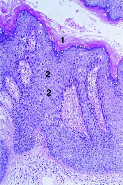 Vulval Intraepithelial Neoplasia Obgyn Key