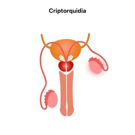 Крипторхидия Болезнь яичек Мужчина крипторхизм Боль Патология яичек