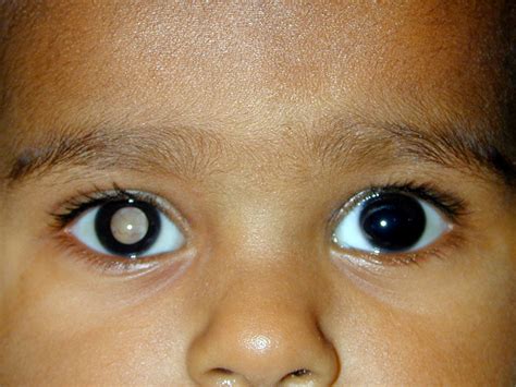 Retinoblastoma Aravind Eye Care System