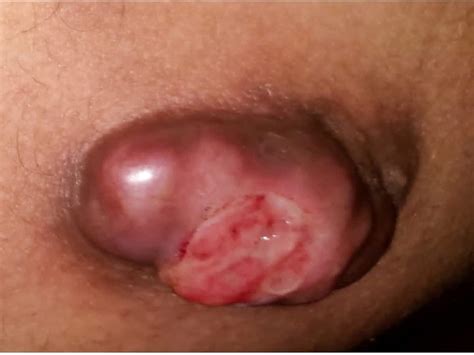 Leuco Sarcoma Cancer 4cm Tumor Removed From A 38 Year Old Mans